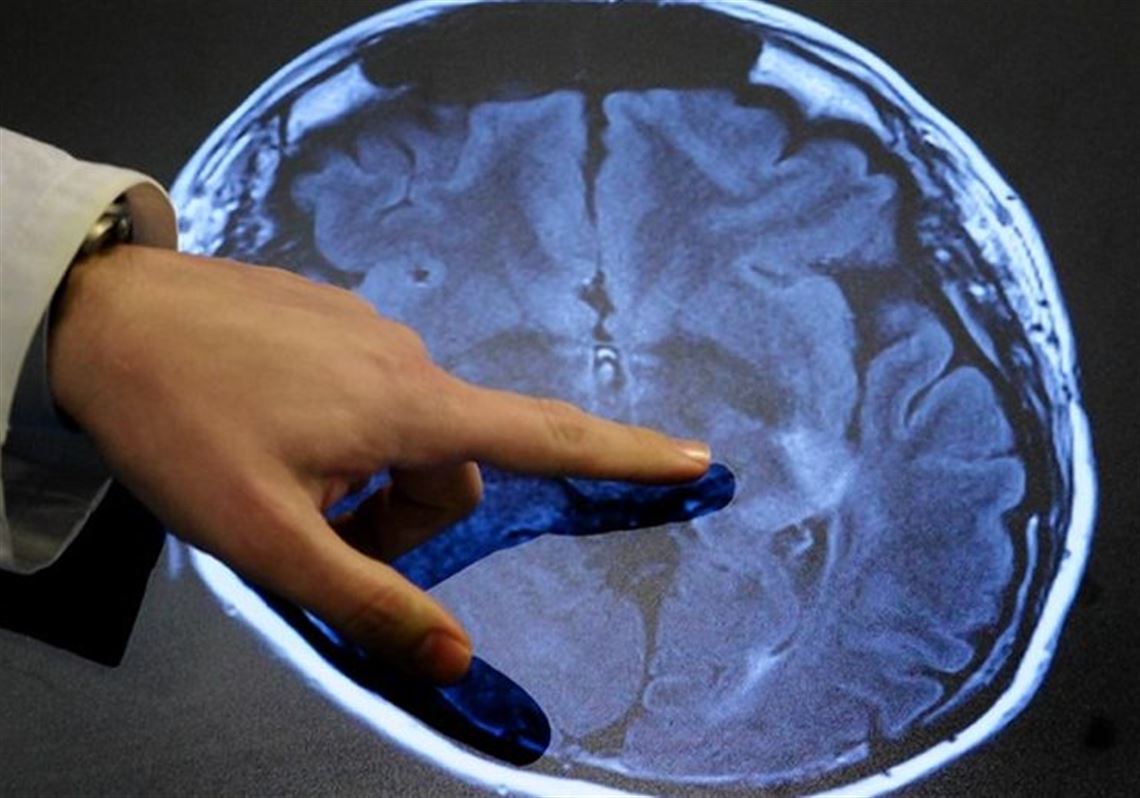 Stroke procedure shown to be effective even after treatment deadline ...